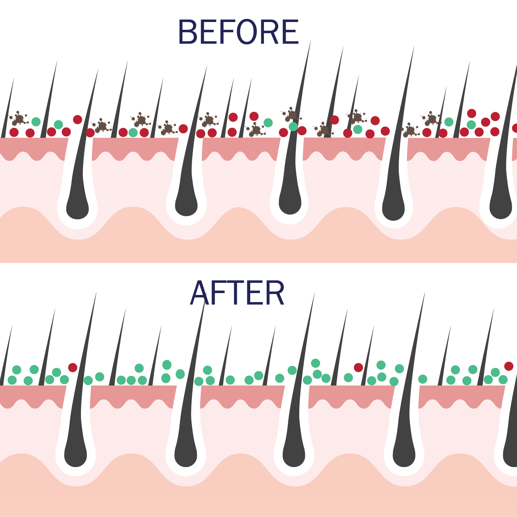 Probiotic works by targeting the main offender of acne